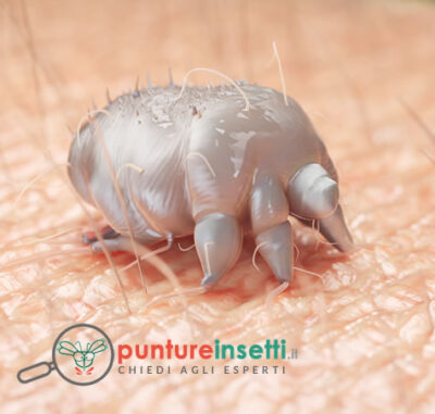 Punture Acaro Scabbia Riconoscere La Malattia | PuntureInsetti.it
